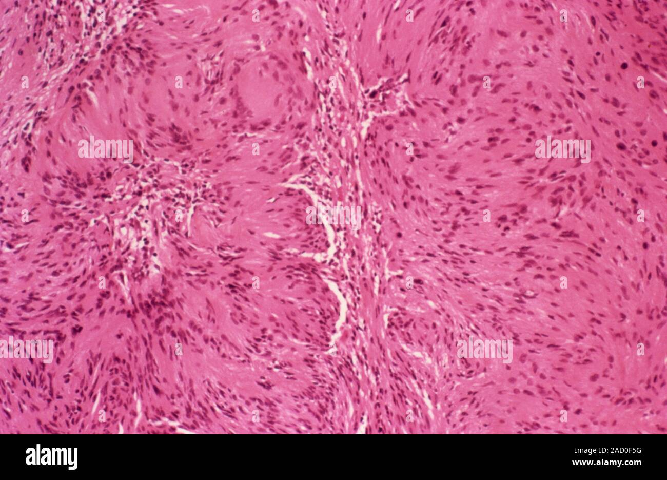 Nerve tumour. Light micrograph of a section through a schwannoma in a ...