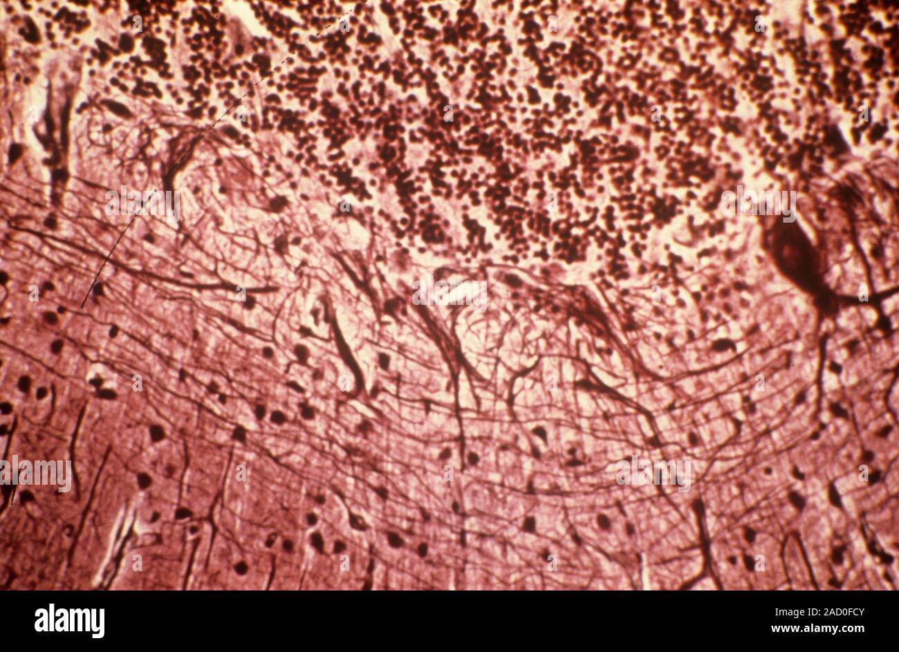 Alcoholic cerebellar atrophy. Light micrograph of a section through a ...
