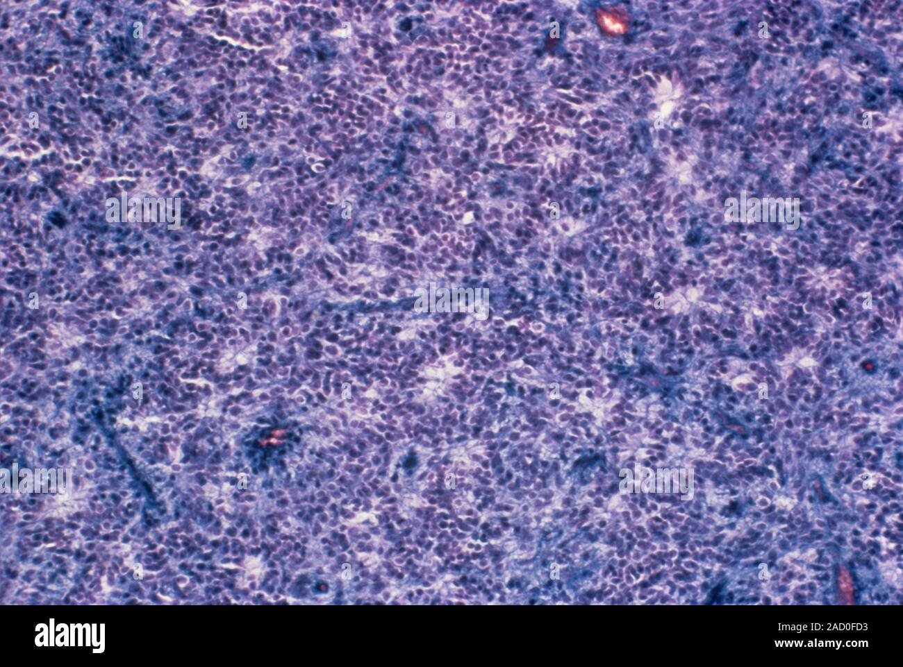 Nervous System Tumour Light Micrograph Of A Section Through An Ependymoma A Rare Benign Non