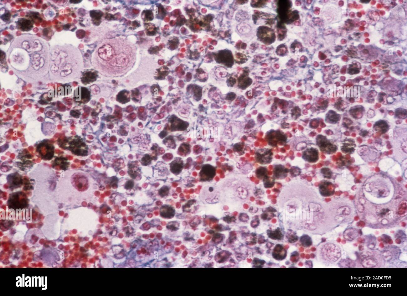 Secondary brain cancer. Light micrograph of a section through a ...