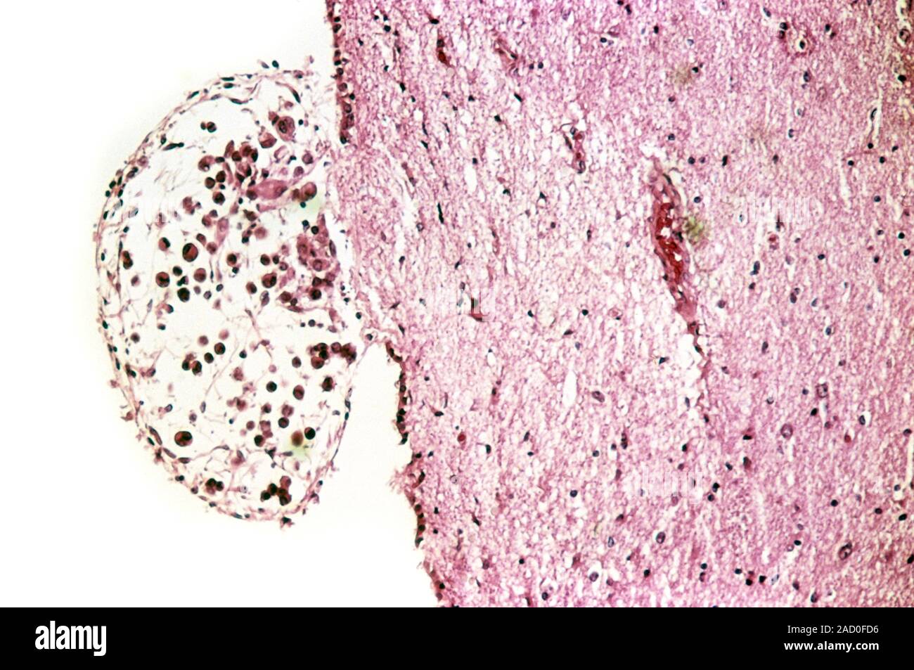 Secondary brain cancer. Light micrograph of a section through a ...