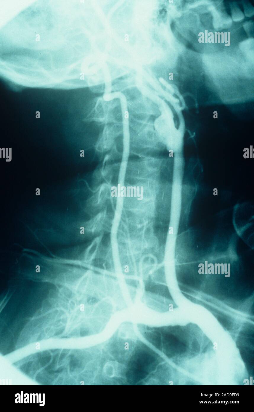 Arterial aneurism. X-ray of a section through the neck of a patient ...