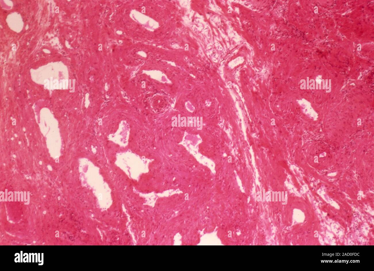 Uterine tumour. Light micrograph of a section through an angioleiomyoma ...
