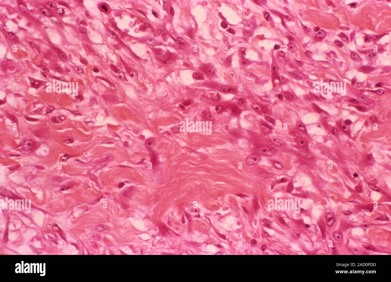 Fasciitis. Light micrograph of a section through tissue affected by ...