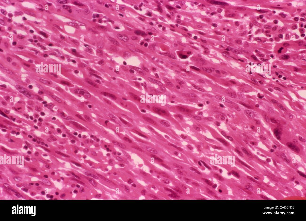 Fibrosarcoma. Light micrograph of a section through a fibrosarcoma, a ...