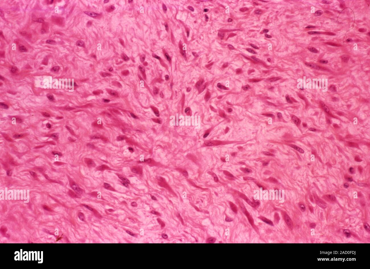 Fibrosarcoma. Light micrograph of a section through a fibrosarcoma, a ...
