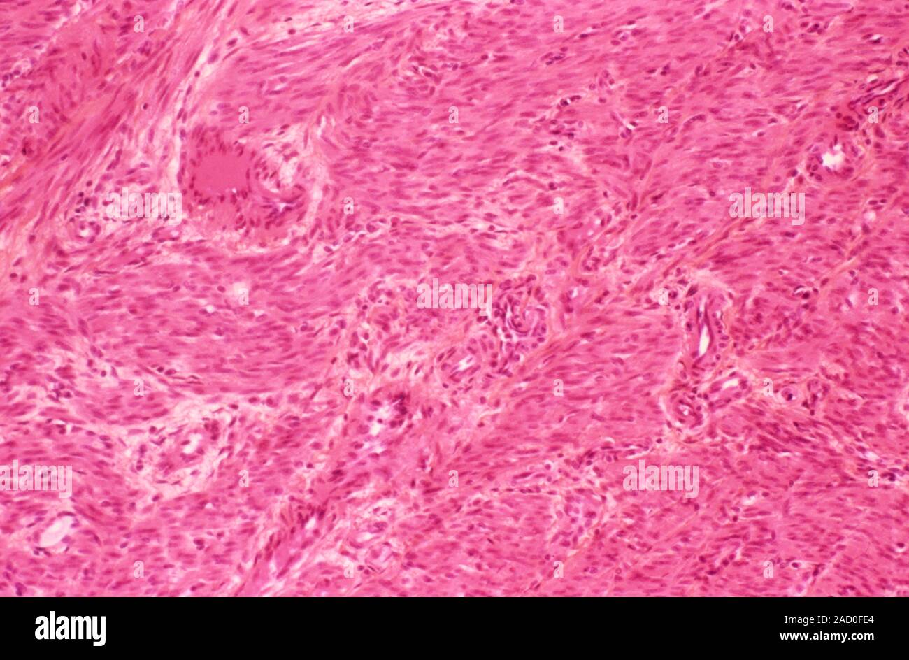 Uterine tumour. Light micrograph of a section through an angioleiomyoma ...