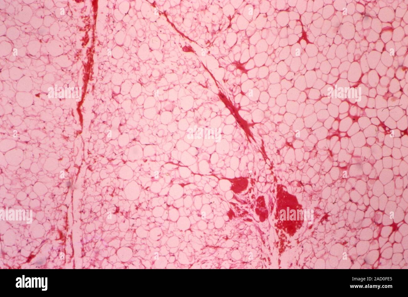 Lipoma. Light micrograph of a section through a lipoma in adipose (fat ...
