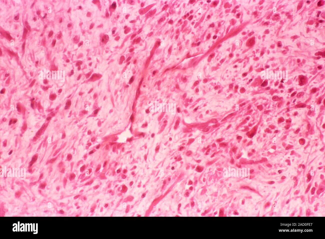 Liposarcoma. Light micrograph of a section through a liposarcoma in ...