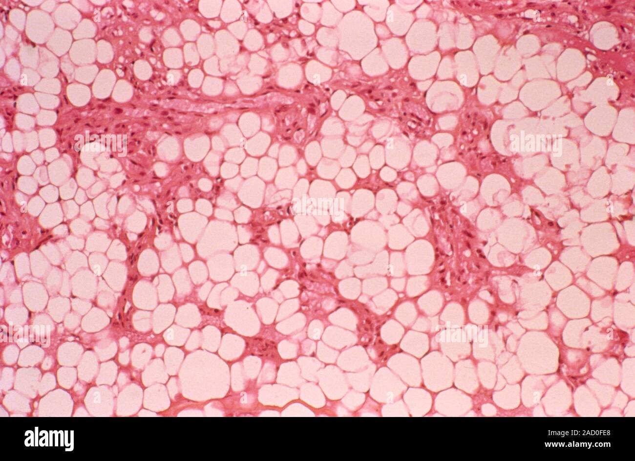 Lipoma. Light micrograph of a section through a lipoma in adipose (fat ...