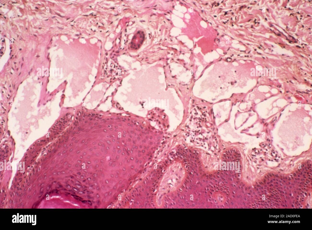 Lymphangioma. Light micrograph of a section through a lymphangioma from ...