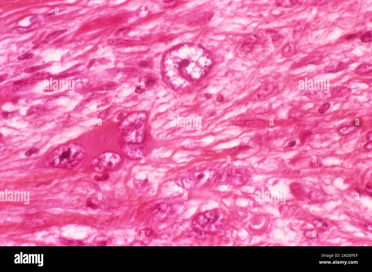 Rhabdomyosarcoma. Light micrograph of a section through a ...
