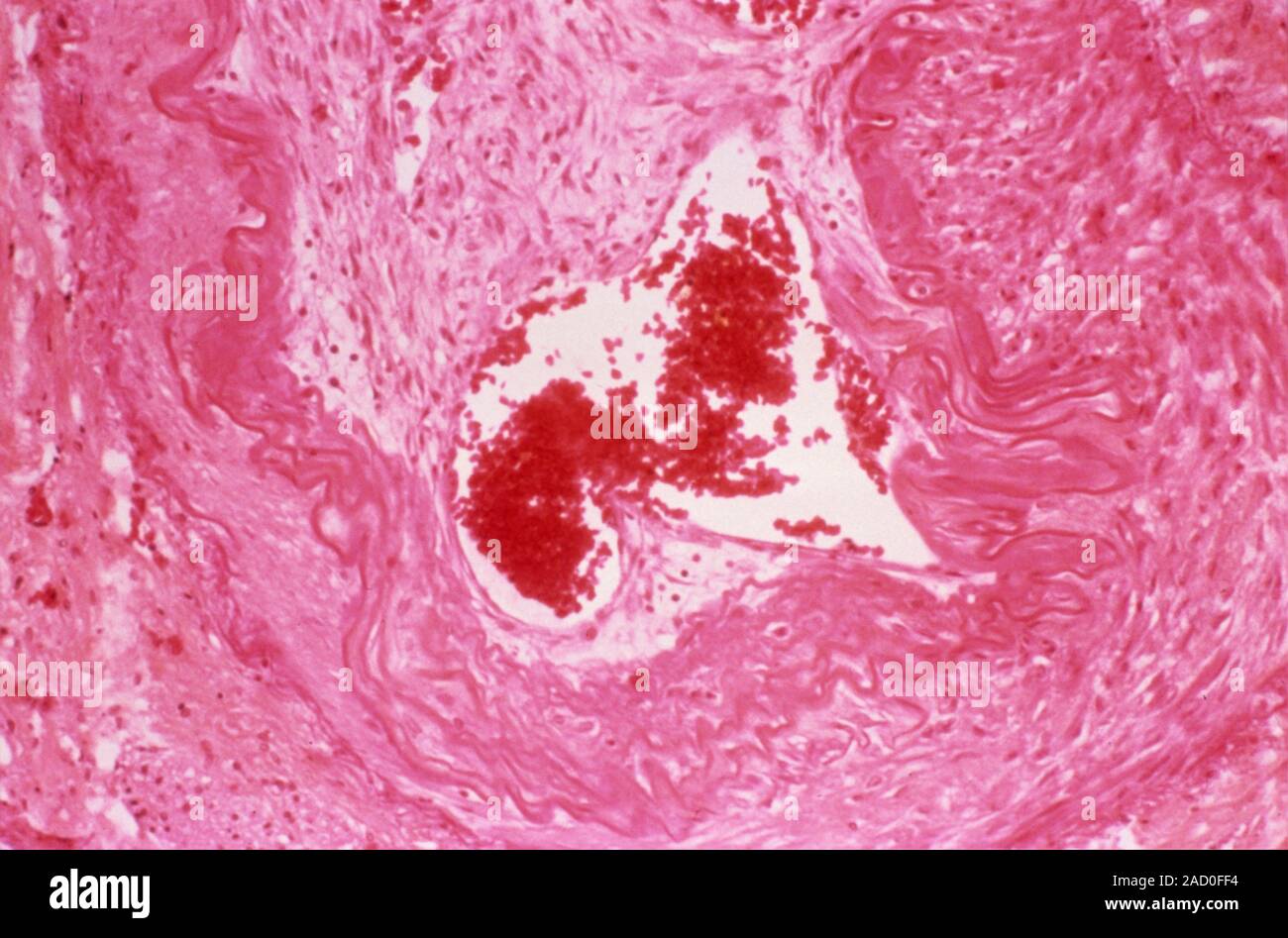 Thrombosed artery. Light micrograph of a section through a blood clot ...