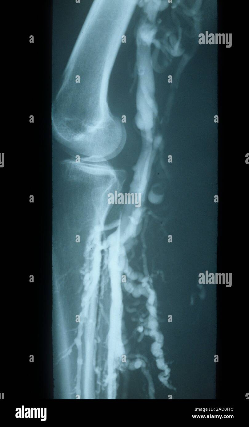 Varicose veins. Venogram X-ray of a varicose veins in a patient's leg ...