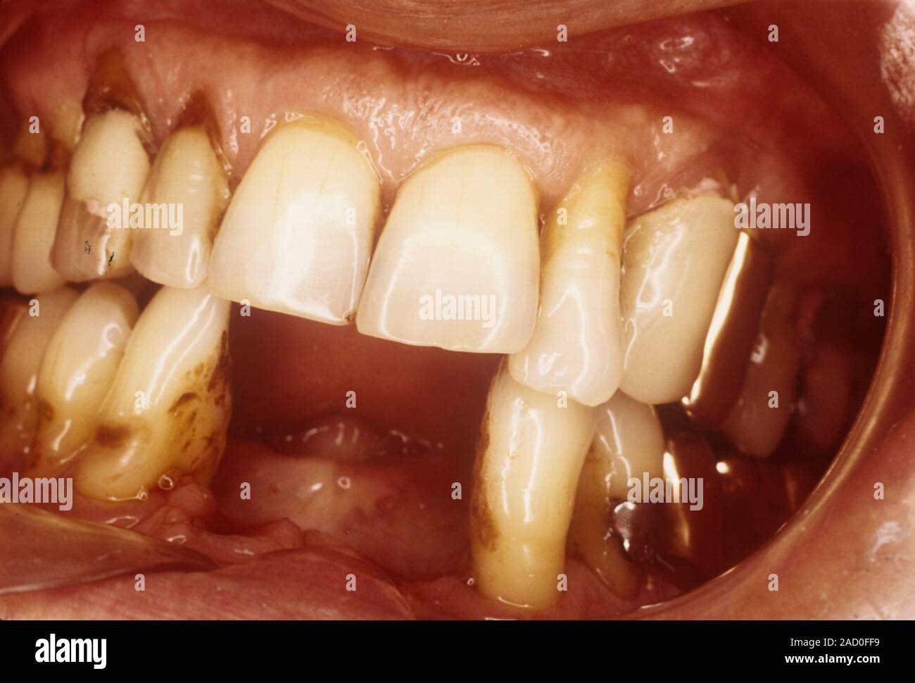 Missing teeth. Close-up of the mouth of a person who is missing their ...