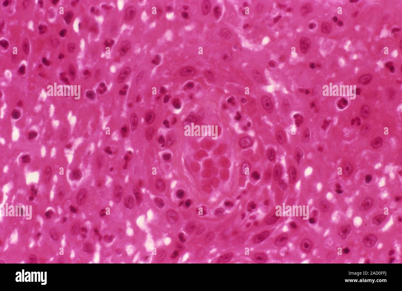 Diapedesis in inflammatory response. Light micrograph of a section ...