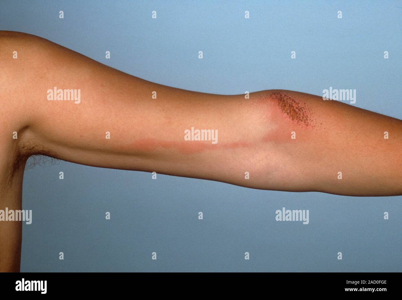 Inflamed lymph vessels in the arm. View of a patient's swollen arm ...