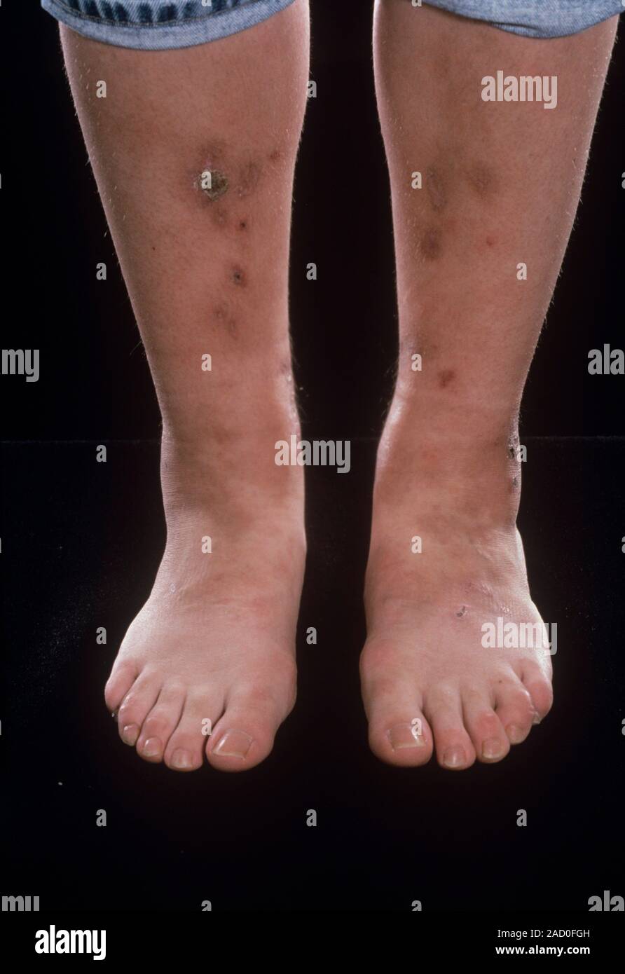 White atrophy. Close-up of the legs of a patient with white atrophy ...