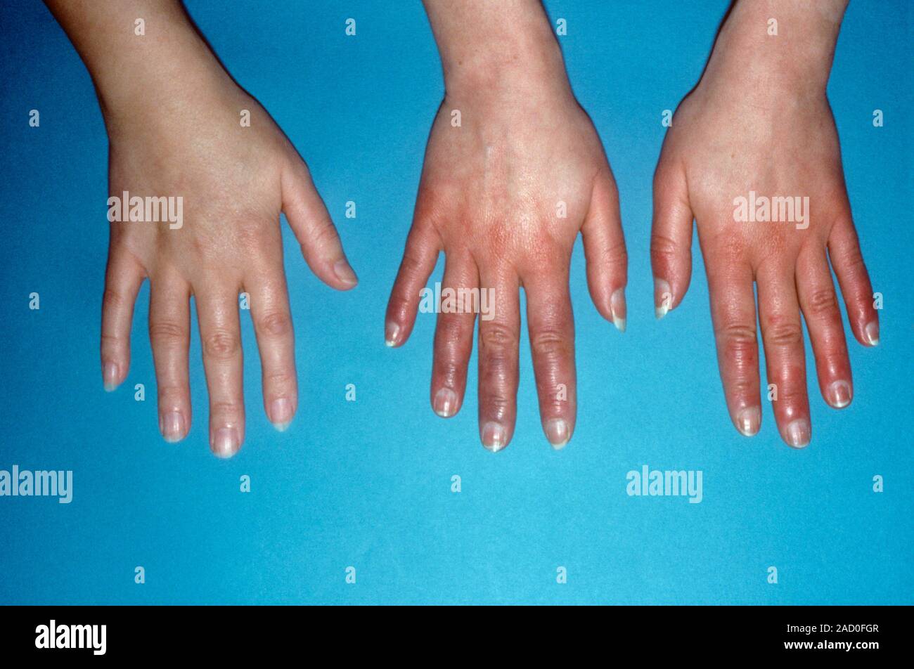 Acrocyanosis of the hands. Close-up of the hands of patient affected by ...