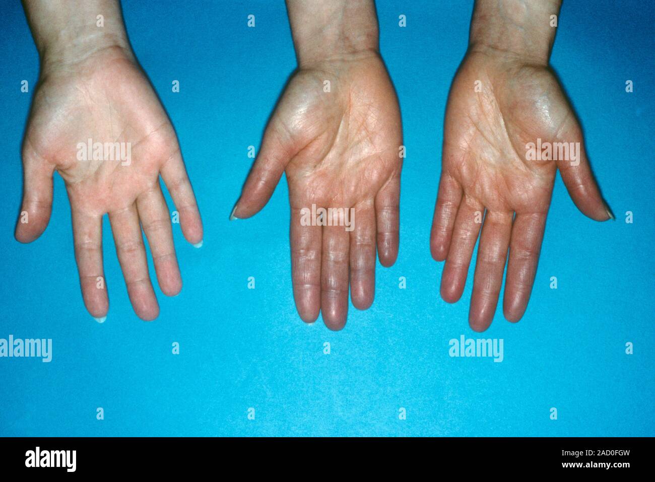 Acrocyanosis of the hands. Close-up of the hands of patient affected by ...