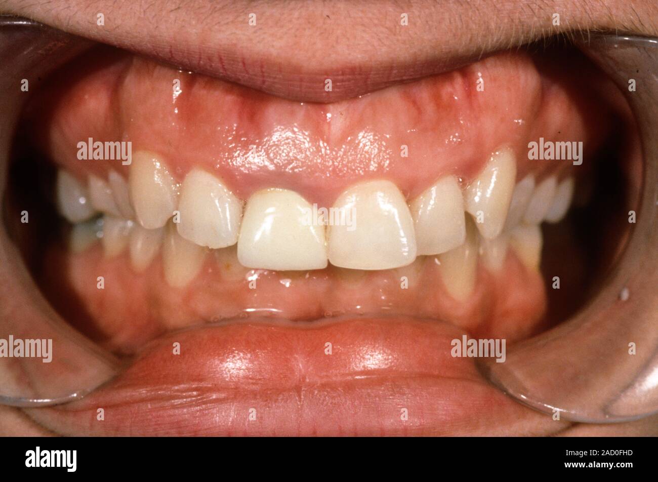 Maxillary prognathism. Close-up of the teeth of an orthodontic patient ...