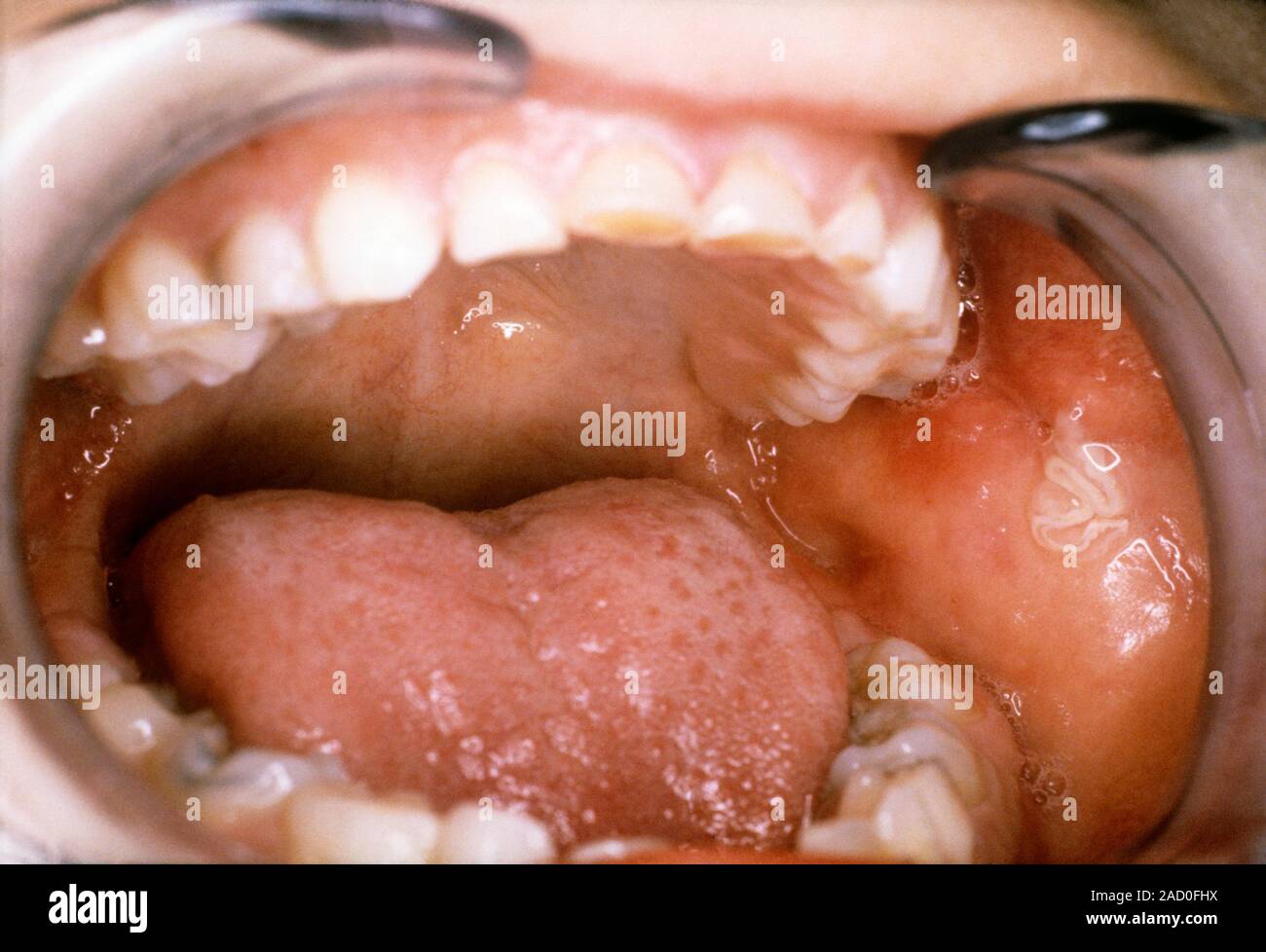 Parotid Gland Swelling Inside Mouth RACGP Common Causes Of Swelling
