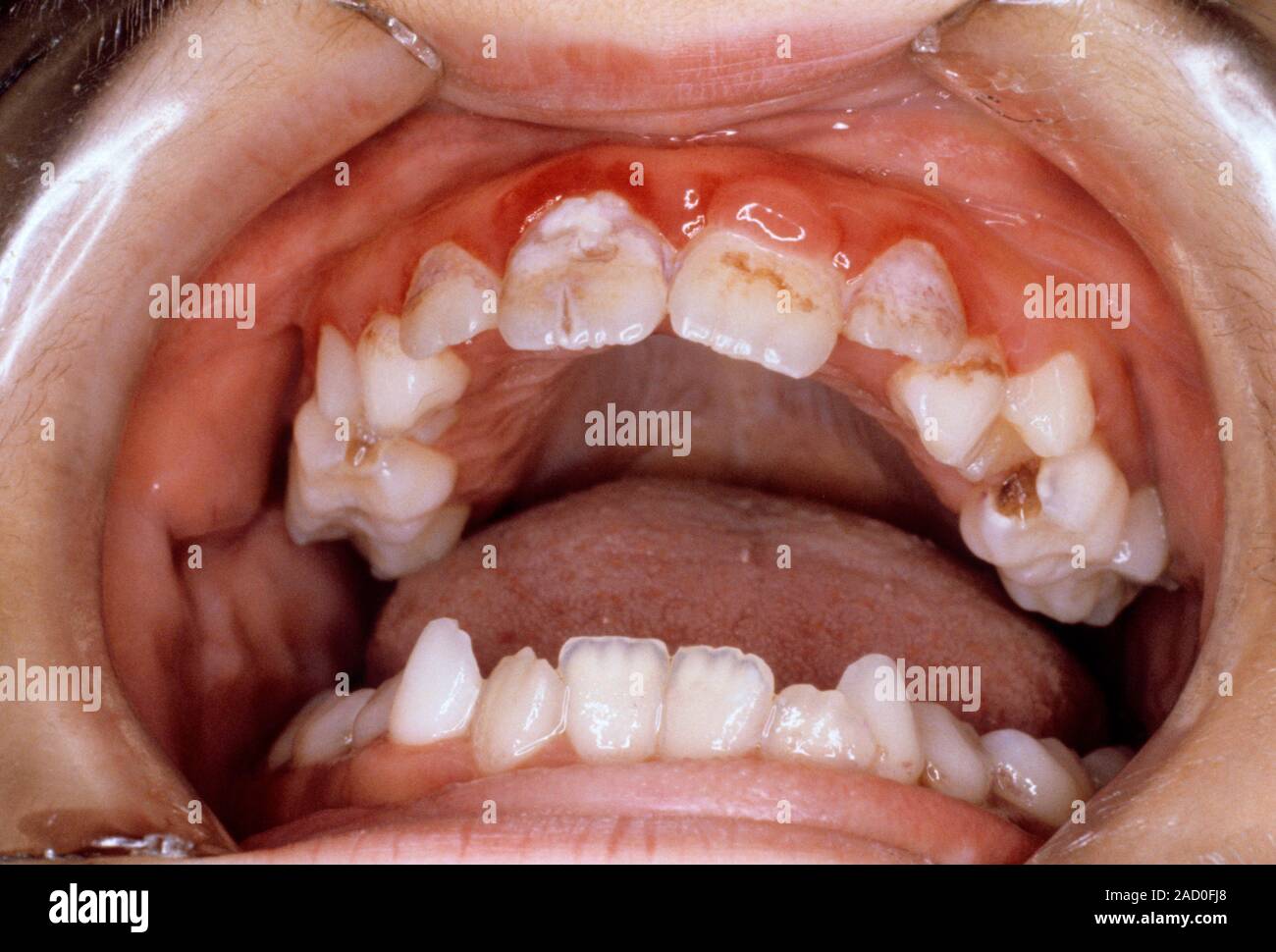Enlarged gums. Close-up of the mouth of a patient affected by gingival ...