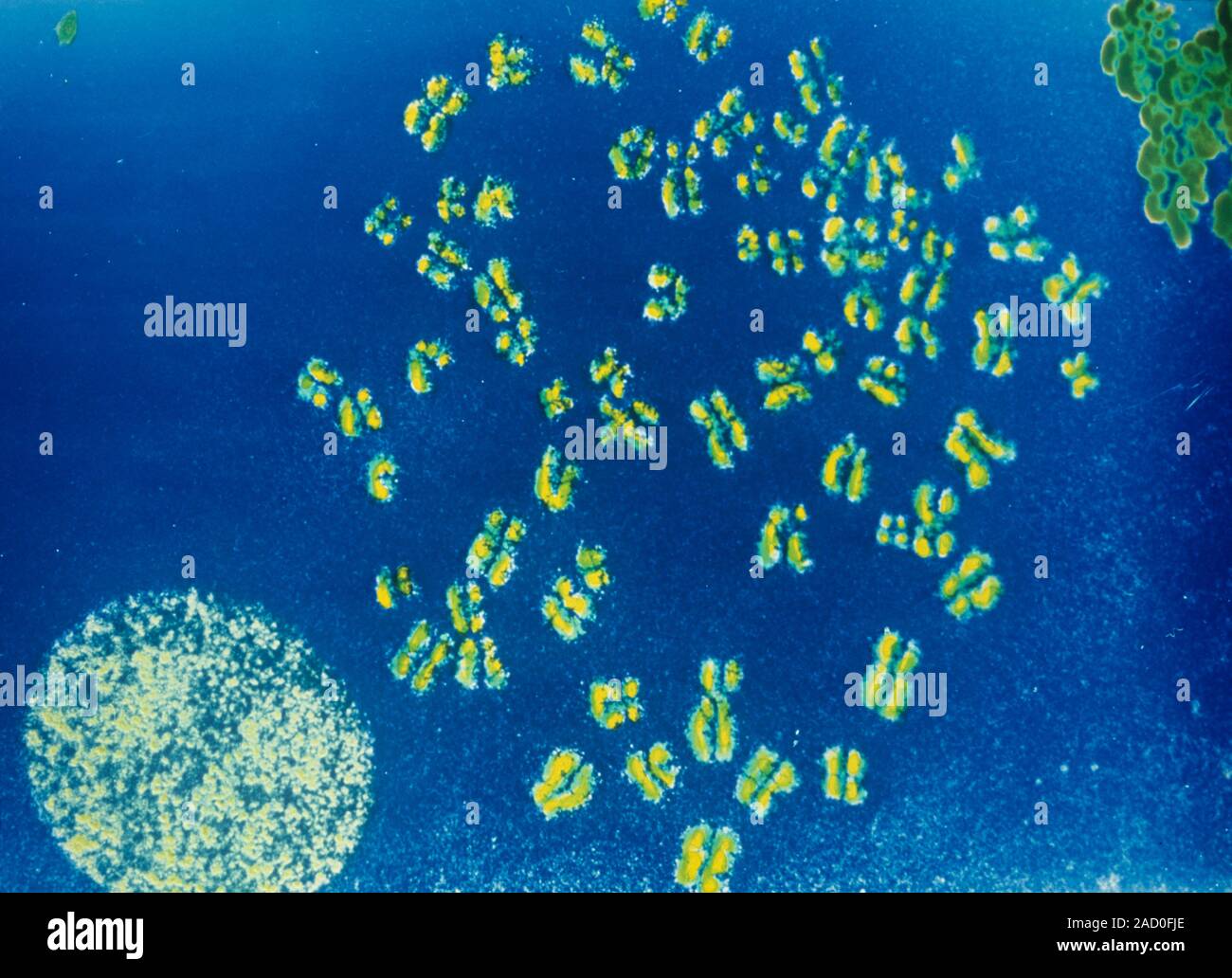 Chromosomes in a cancer cell. Coloured scanning electron micrograph ...
