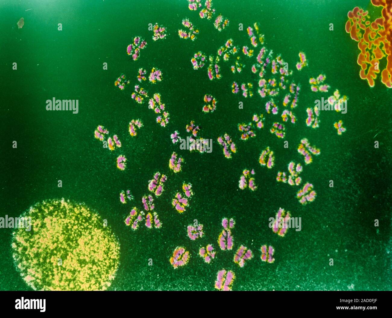 Chromosomes in a cancer cell. Coloured scanning electron micrograph ...