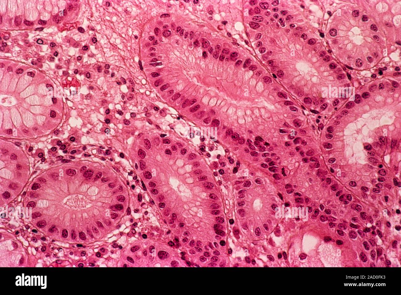 Stomach metaplasia. Light micrograph of a section through tissue from ...