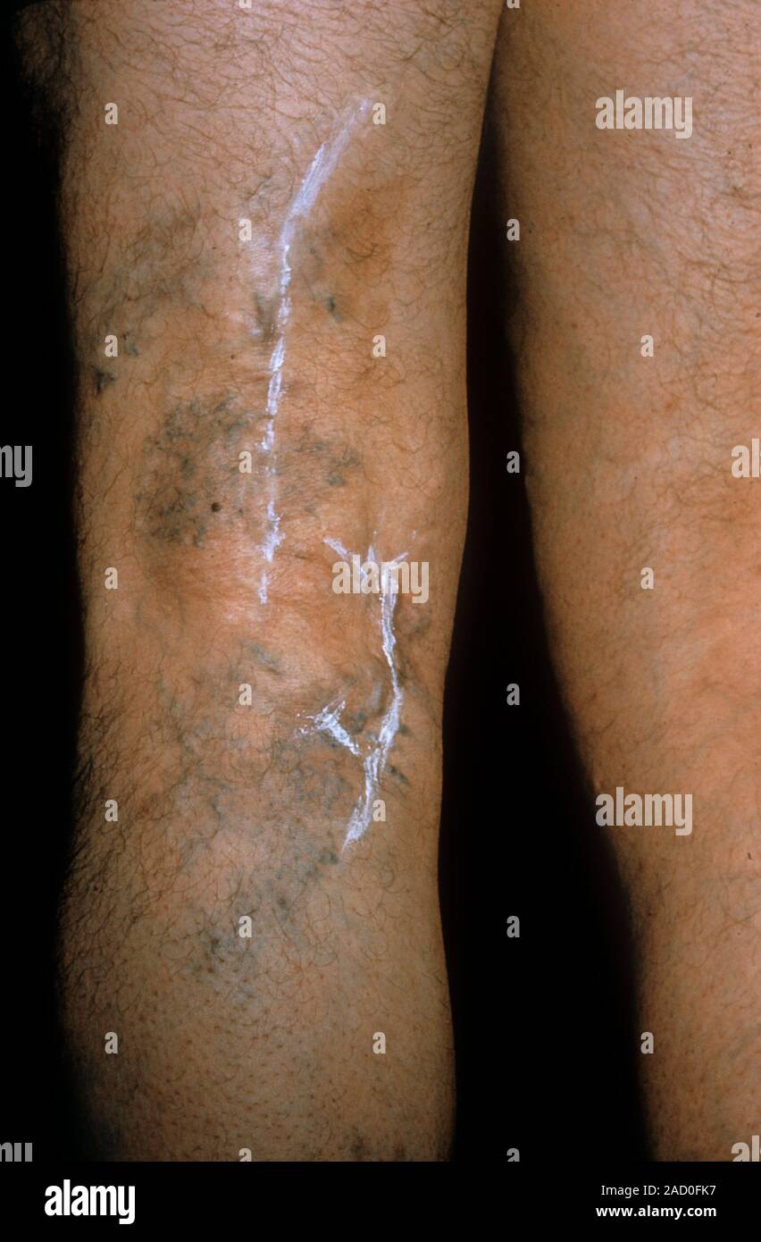 Klippel-Trenaunay-Weber syndrome. Hypertrophy of a patient's leg with ...
