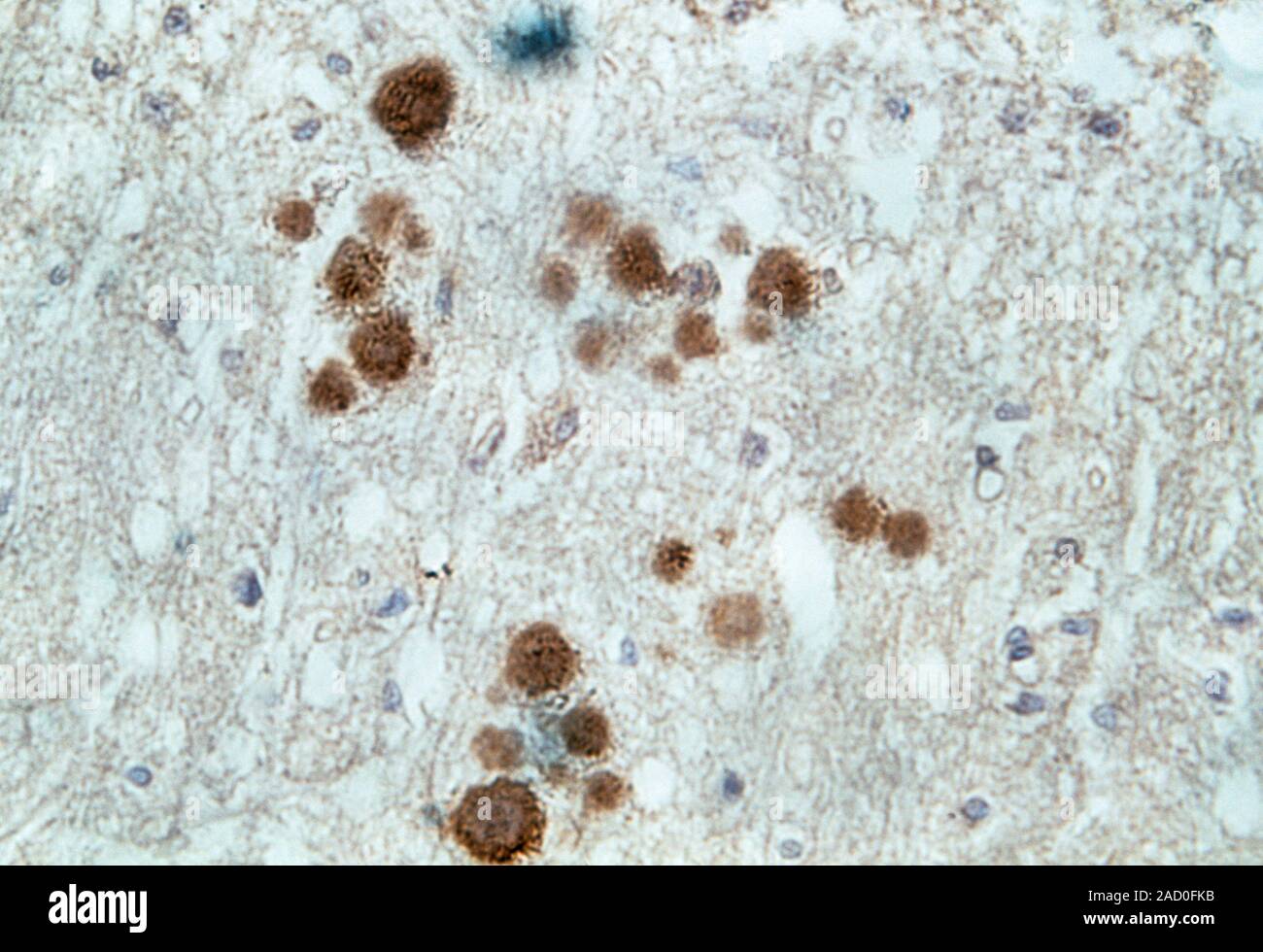 Gerstmann-Straussler-Scheinker syndrome. Immunohistochemistry light ...