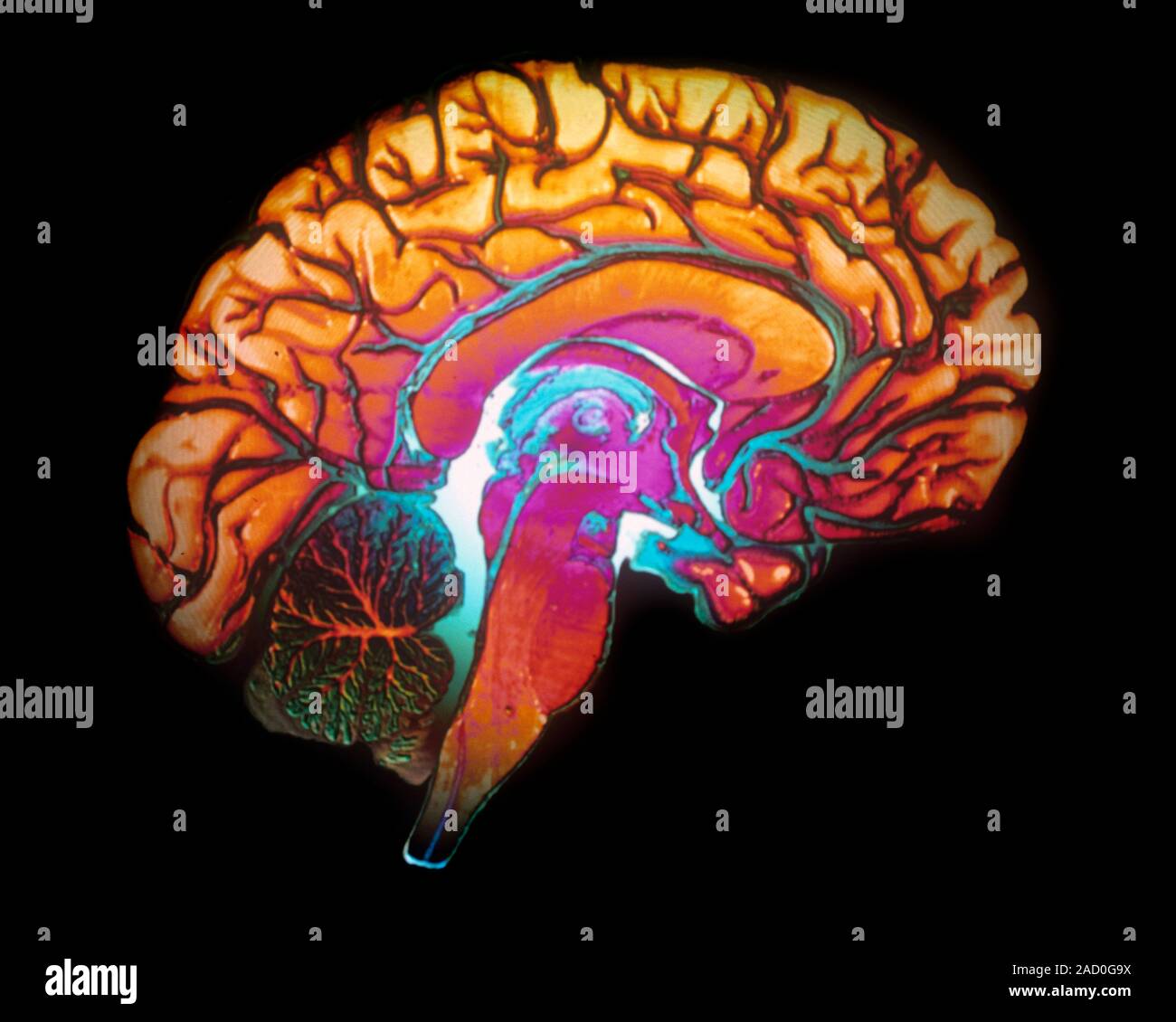 Human brain. Coloured 3D magnetic resonance imaging (MRI) scan of sagittal section through a ...