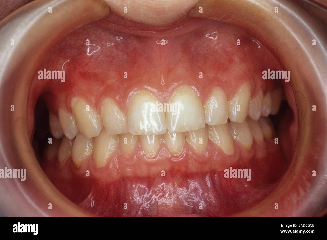 Healthy adult teeth. Humans are omnivores, and have 32 permanent teeth ...