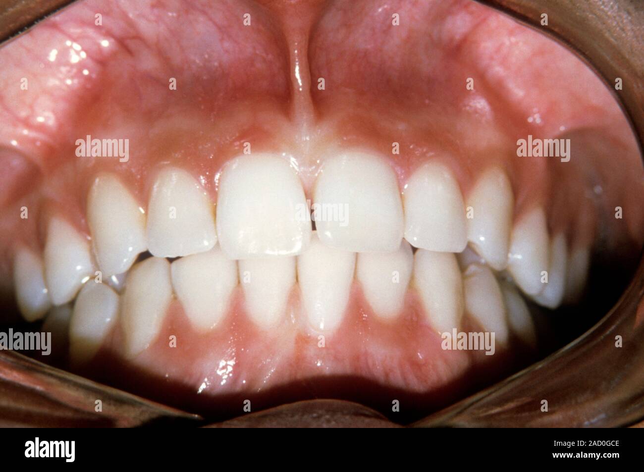Healthy adult teeth. Humans are omnivores, and have 32 permanent teeth ...