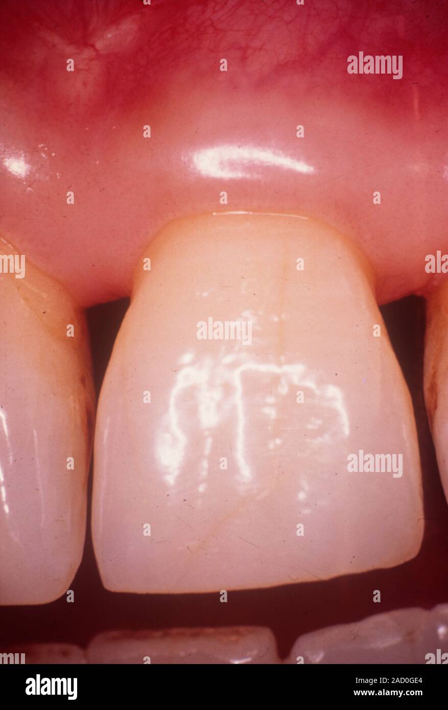 Healthy adult tooth. This is an incisor, found at the front of the jaw ...