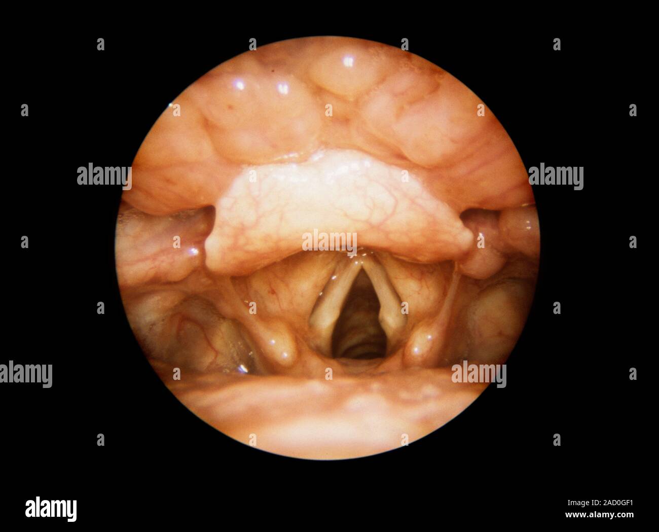 Vocal cords. Bronchoscope image showing the human vocal cords at rest ...