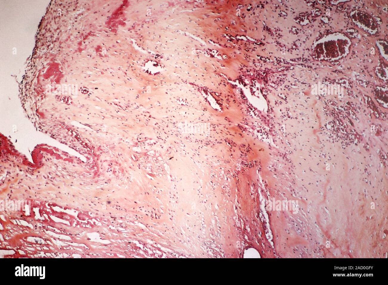 Syphilitic aortitis. Light micrograph of a section through the wall of ...