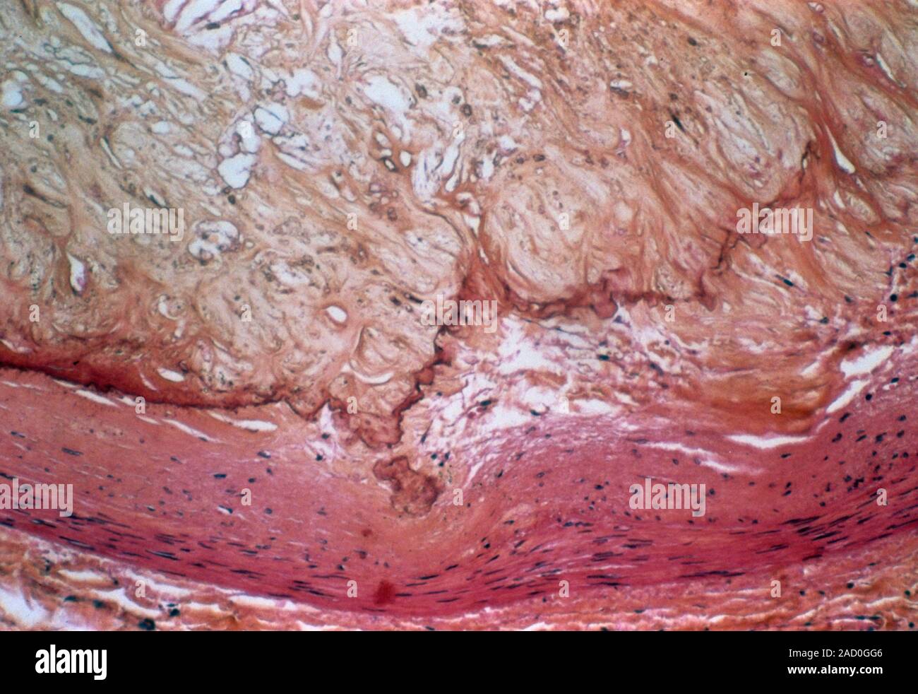 Atherosclerosis. Light micrograph of a section through part of a human ...