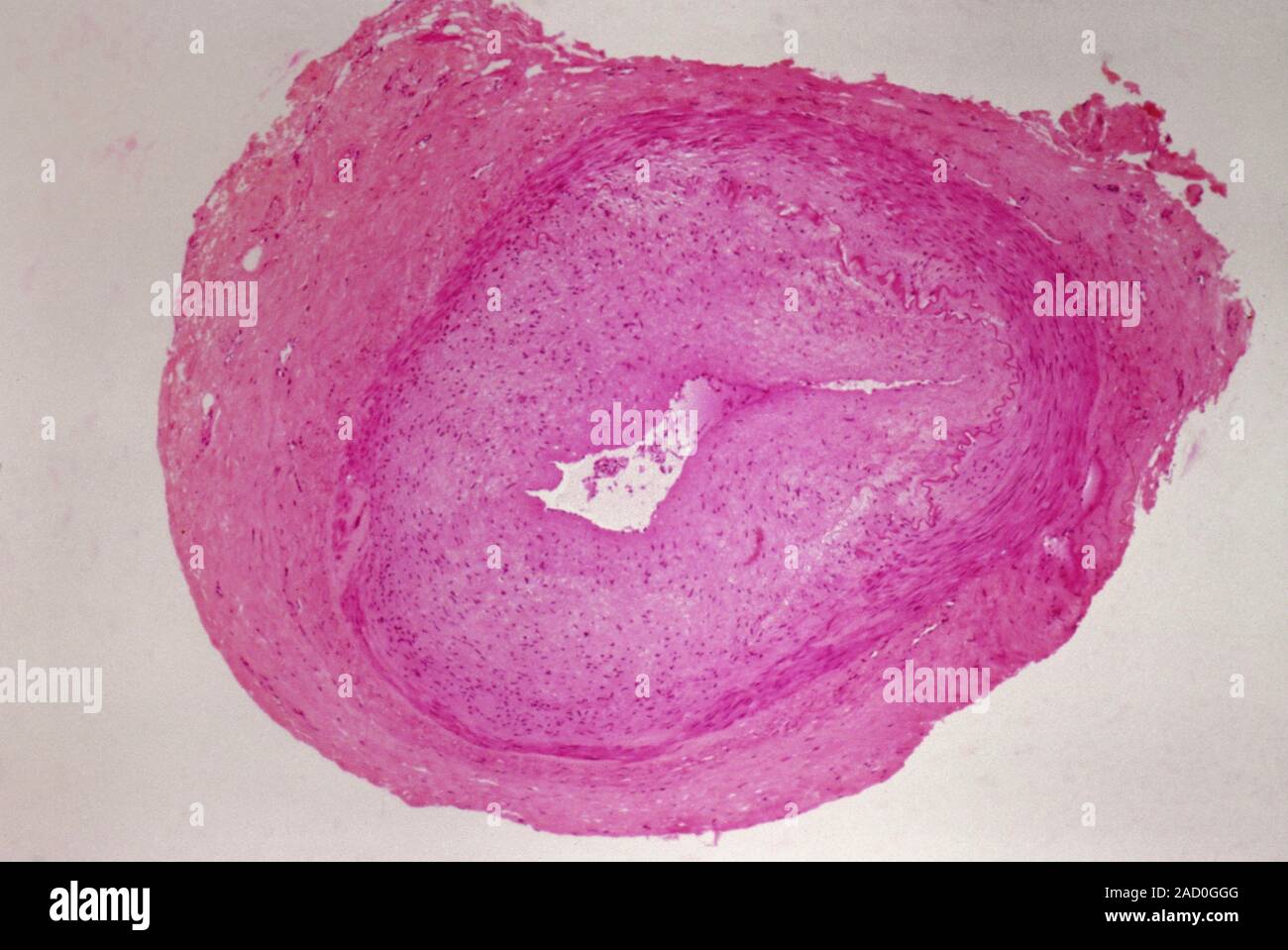 Inflamed artery. Light micrograph of a section through an inflamed ...