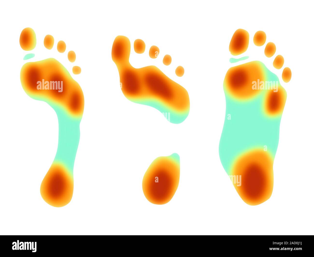 Illustration of a podogram, showing imprints of the sole of the foot ...