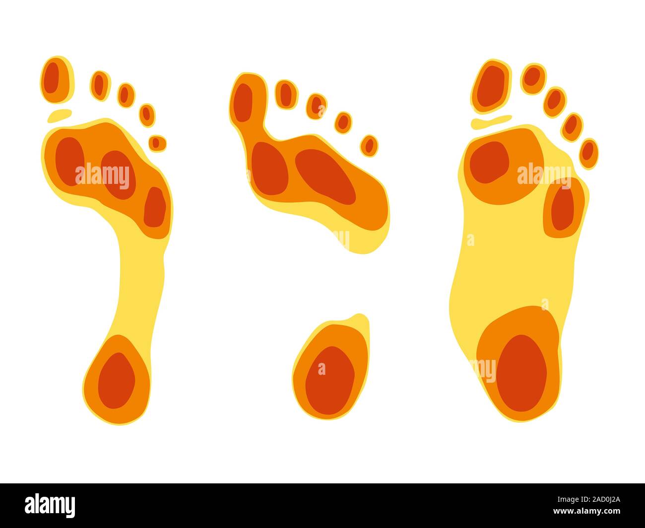 Illustration of a podogram, showing imprints of the sole of the foot ...