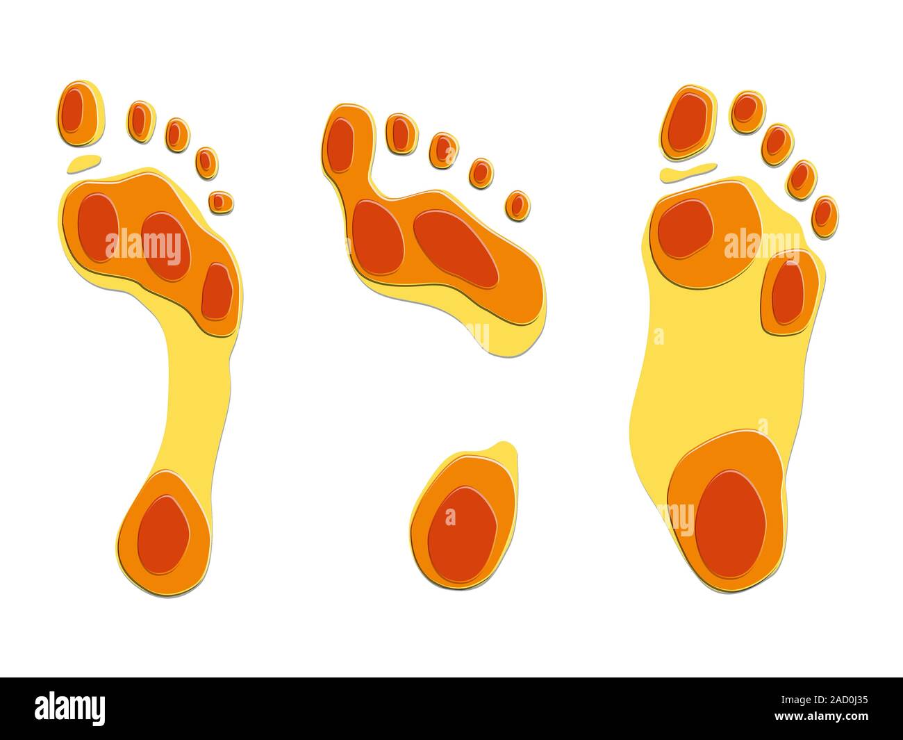 Illustration of a podogram, showing imprints of the sole of the foot ...
