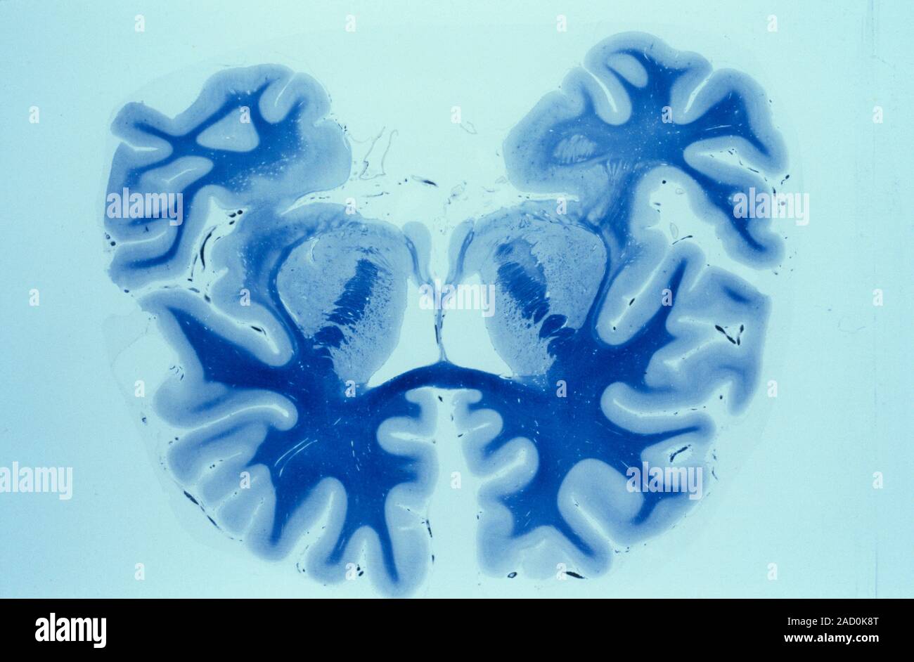 Brain myelin. Light micrograph of a section through a normal brain that ...