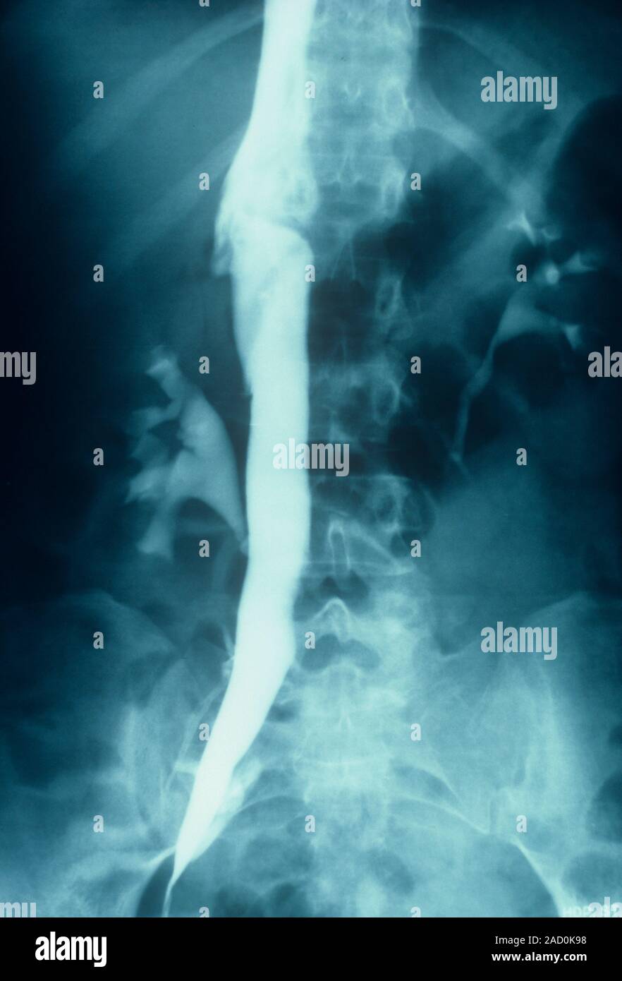 Deep vein thrombosis, X-ray. Venogram of a section through the abdomen ...
