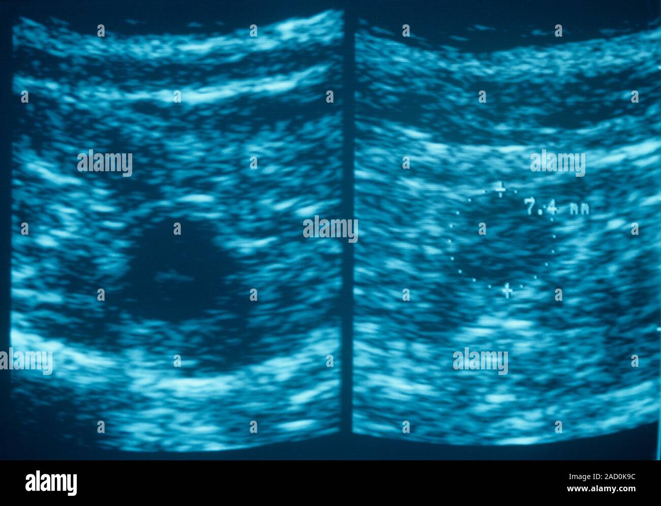 Deep vein thrombosis. Doppler ultrasound scans of the right superficial ...