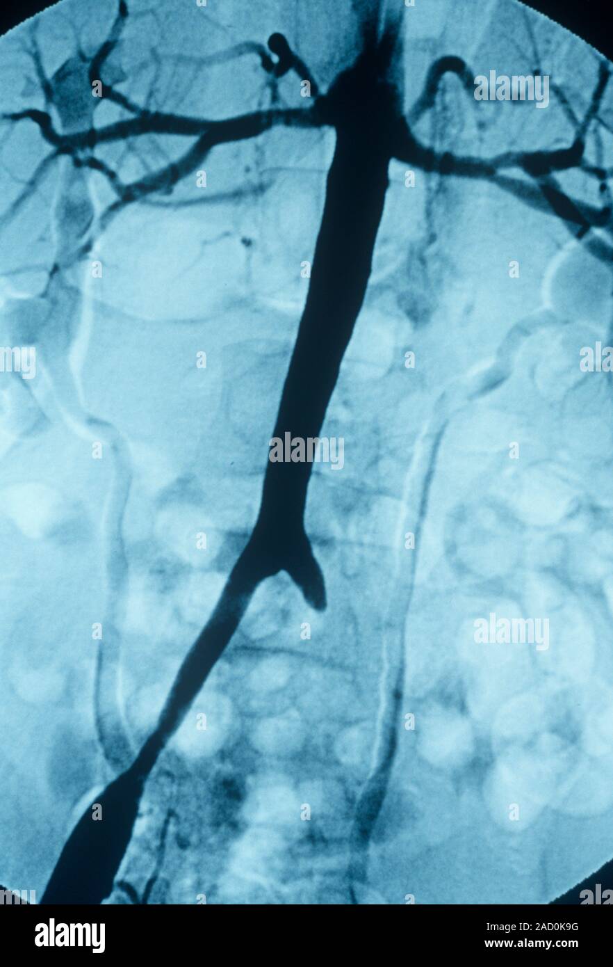 Occluded artery, X-ray. Angiogram of a section through the pelvis of a ...
