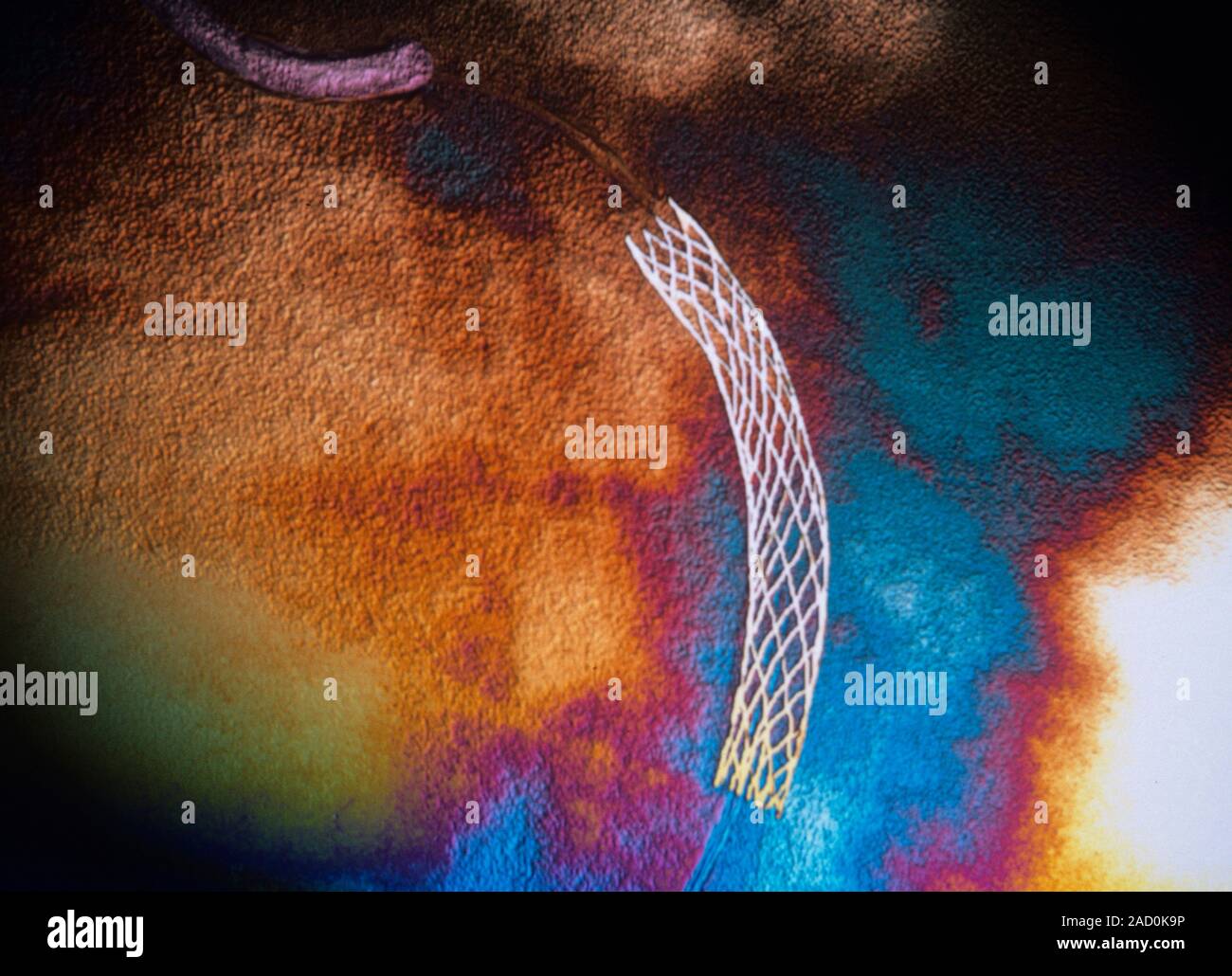 Coronary stent. Coloured angiogram of a section through a heart showing ...