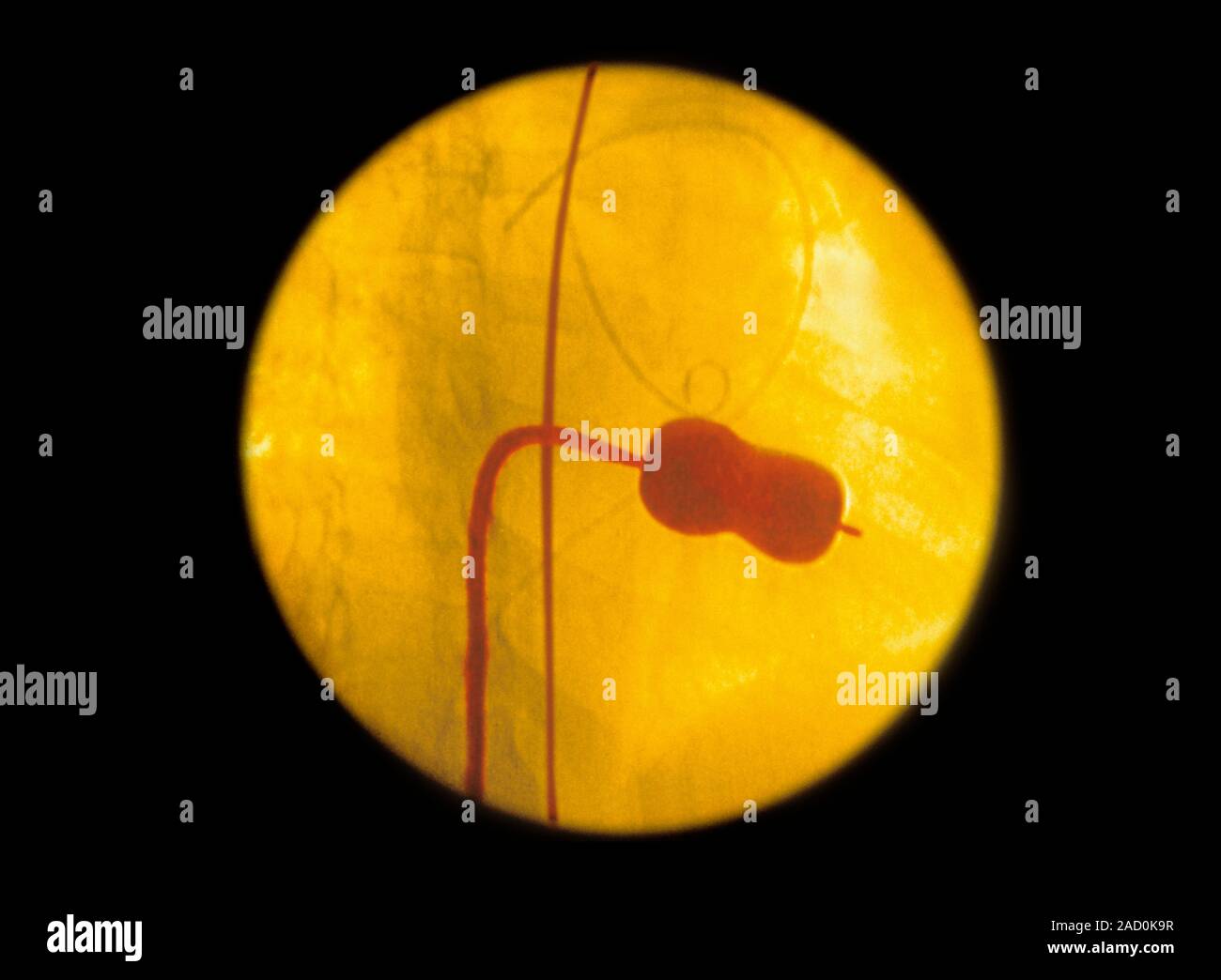Heart valve balloon dilatation, X-ray. Angiogram of a balloon catheter ...