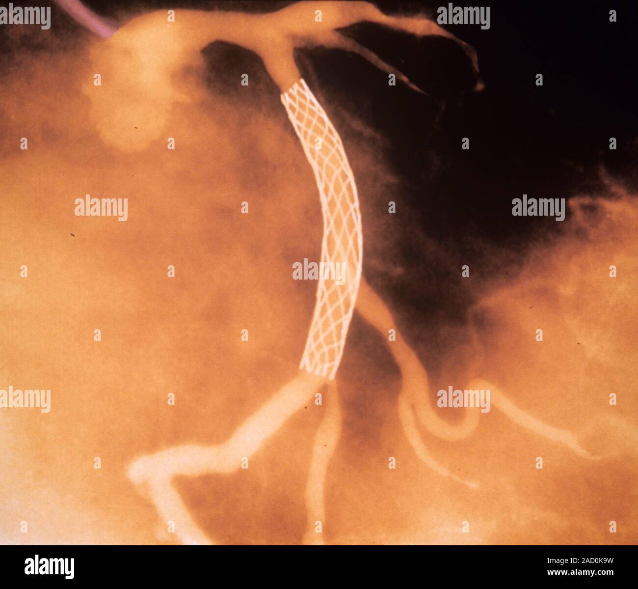 Coronary stent. Coloured angiogram of a section through a heart showing ...